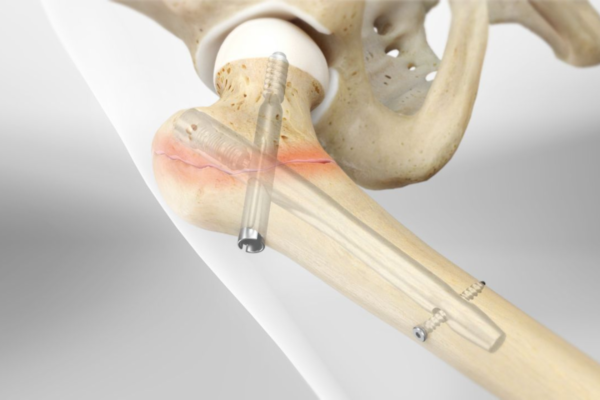 Thigh Fracture Surgery in Quezon City - Tec Orthopedics