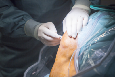 Understanding the Knee Arthroscopy Procedure - Tec Orthopedics