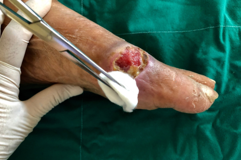 Orthopedic Treatment for Infected Diabetic Foot Wounds - Tec Orthopedics